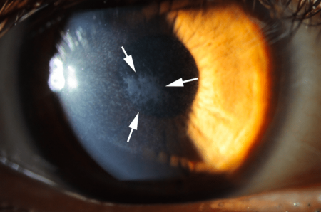Investigating Corneal Wound Healing From Fibrosis In Lung, Kidney, Skin ...