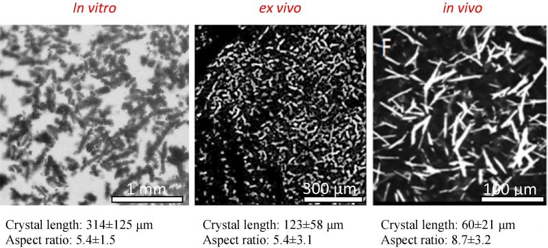Examining Cystine Crystallization In Cystinosis Patients - Science Trends