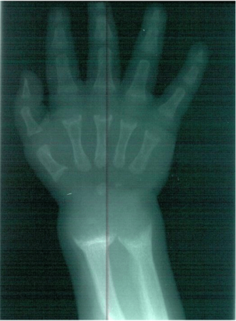 Cardiovascular Risk In Children With Hereditary Rickets - Science Trends