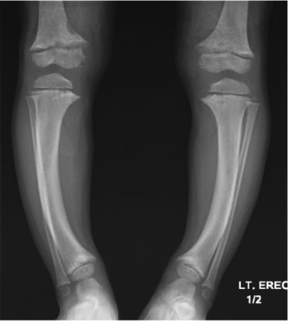 Cardiovascular Risk In Children With Hereditary Rickets - Science Trends